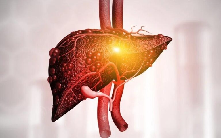 Silent Liver Cirrhosis: Early Signs and Risks